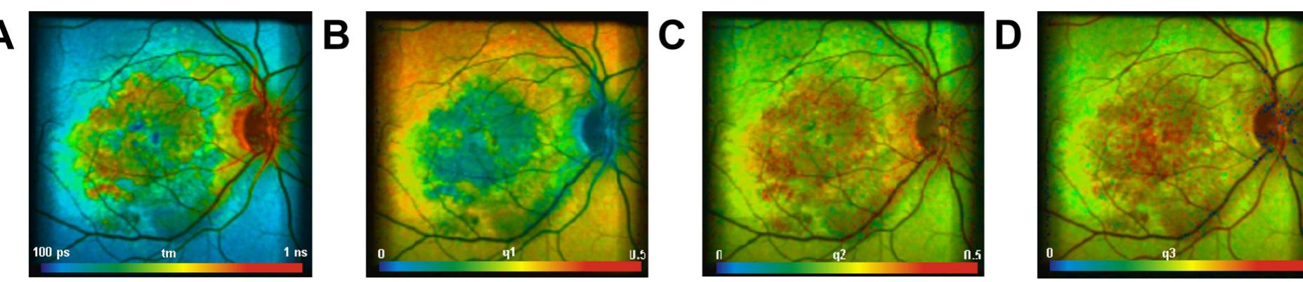 Tcspc lifetime images of the ocular fundus of a patient with