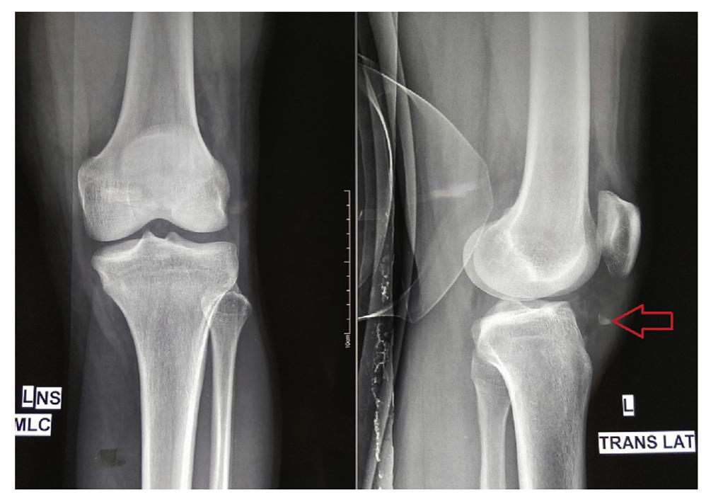X-ray of left knee ap & lateral view (arrow) showing bony