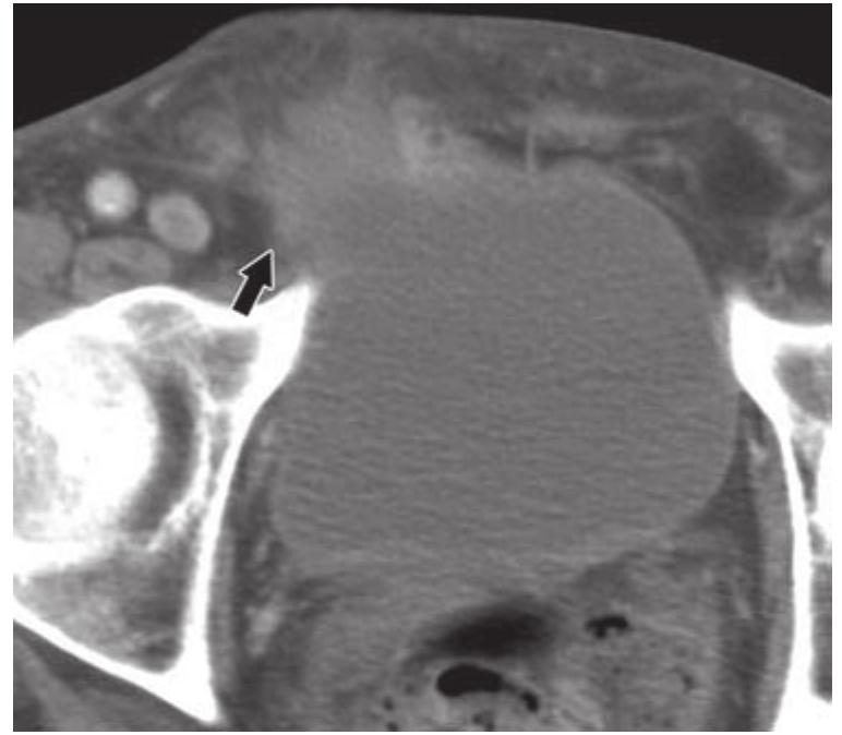 Herniated bladder in a 70-year- old man with