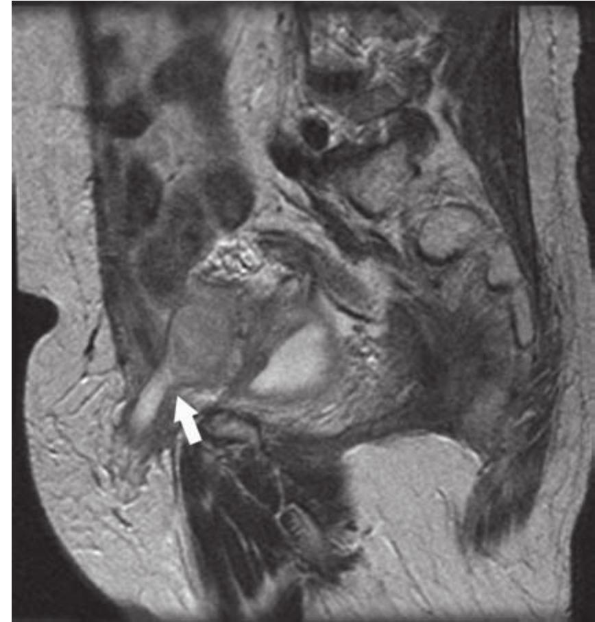 Abscess In A 66 Year Old Man With Rectal Adenocarcinoma