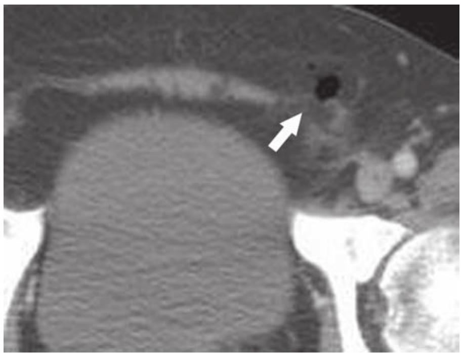 Figure 20 - The Inguinal Canal: Anatomy and Imaging Features