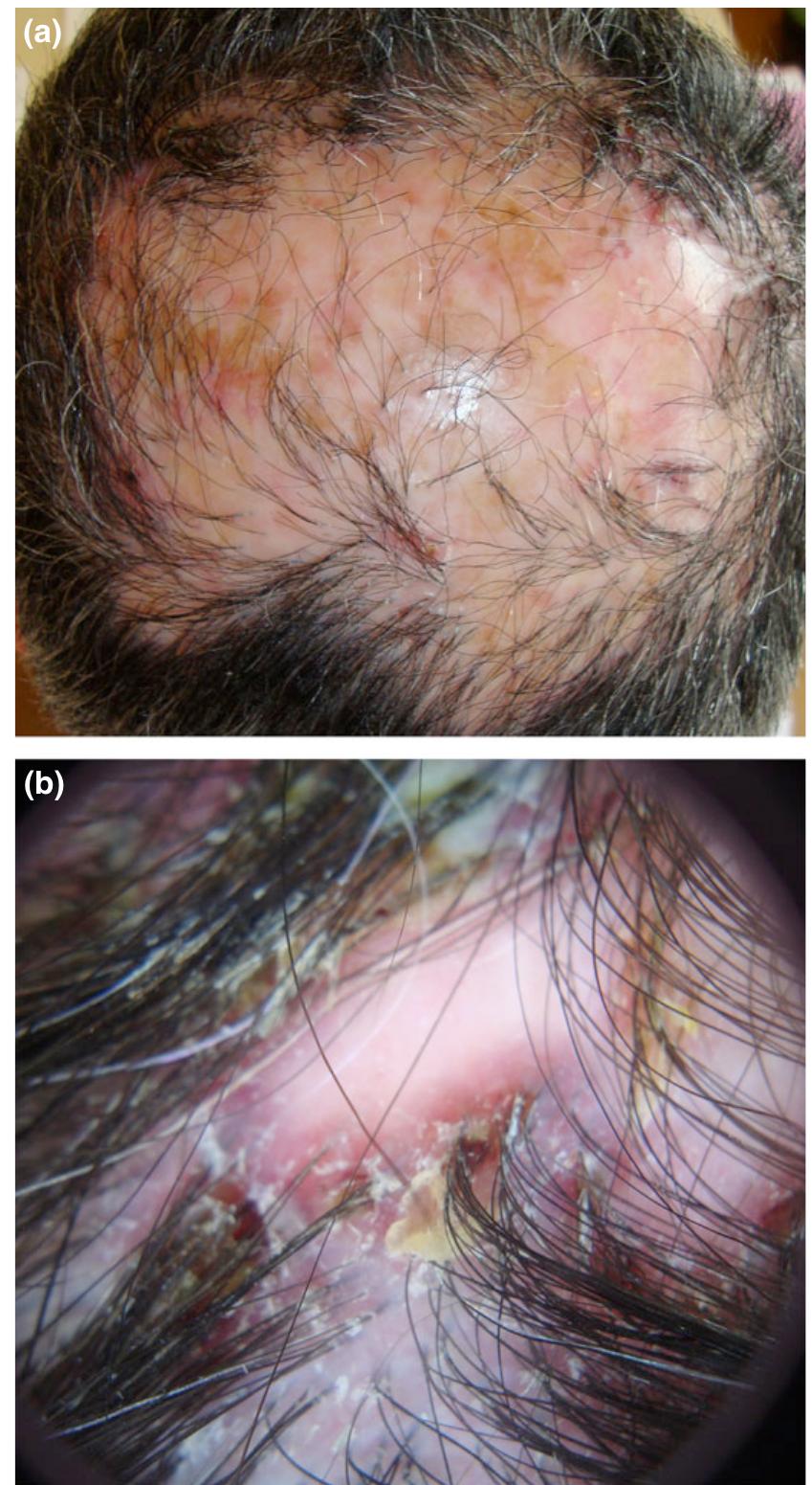 A 42-year-old male with grade ill folliculitis decalvans