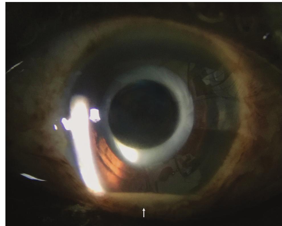 Hypopyon (white arrow) in the anterior chamber in a patient