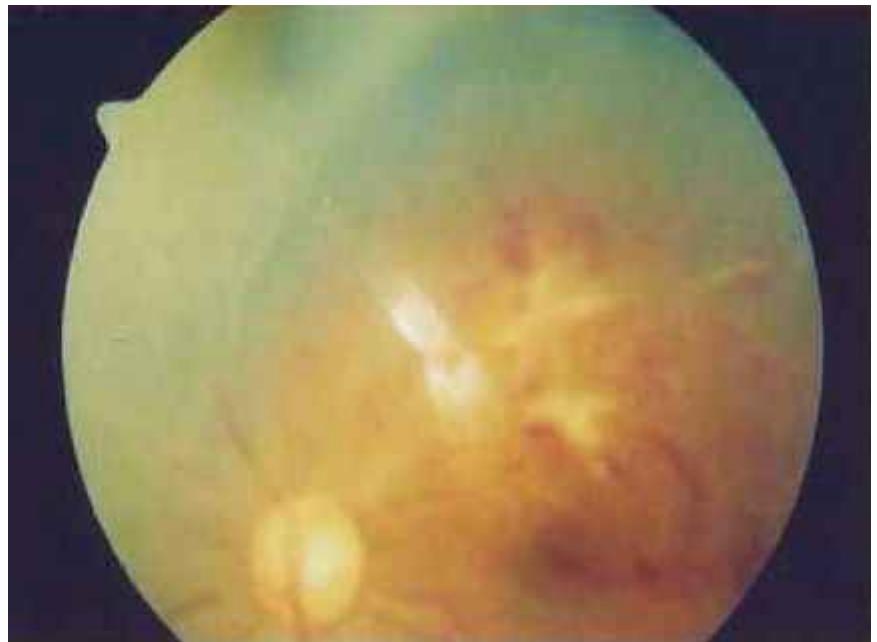 Fundus photograph shows the left eye of a patient with