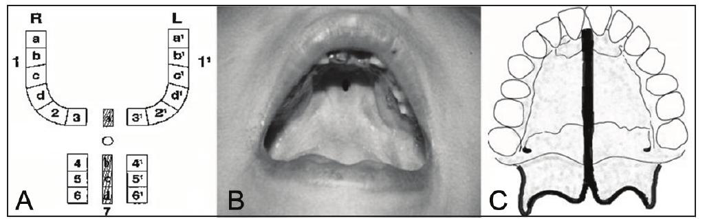 ) a shaded blocks show 7a-submucous cleft palate in the