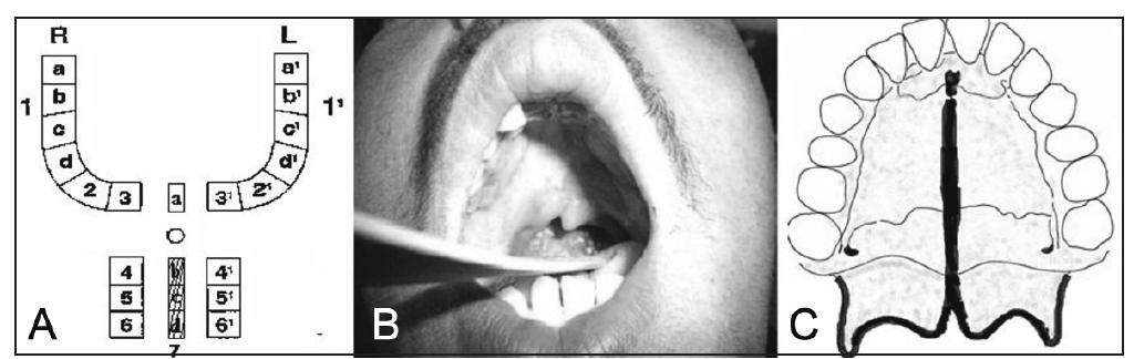) a shaded blocks shows 7 b-submucous cleft palate in the