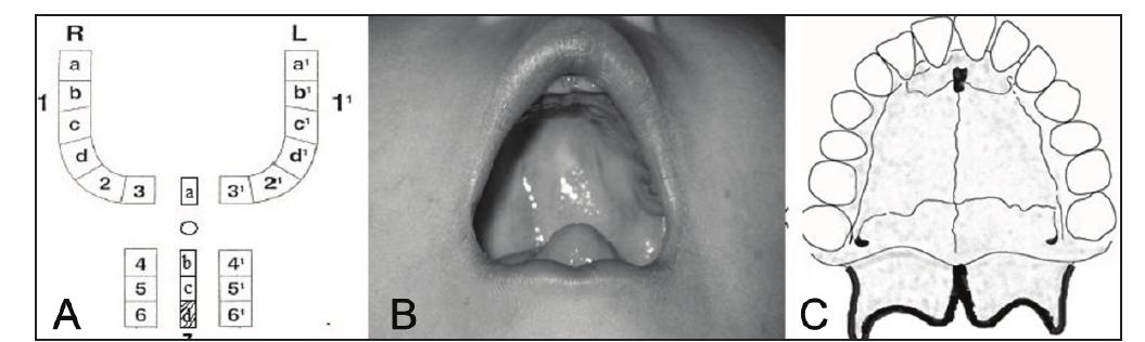 ) a shaded blocks show 7d-submucous cleft palate in the
