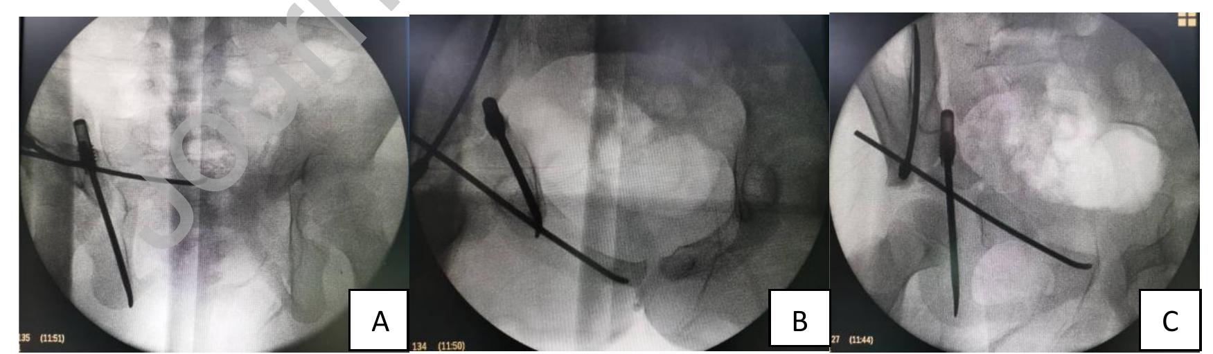 Position of thesupra-acetabular and anterior column tens in