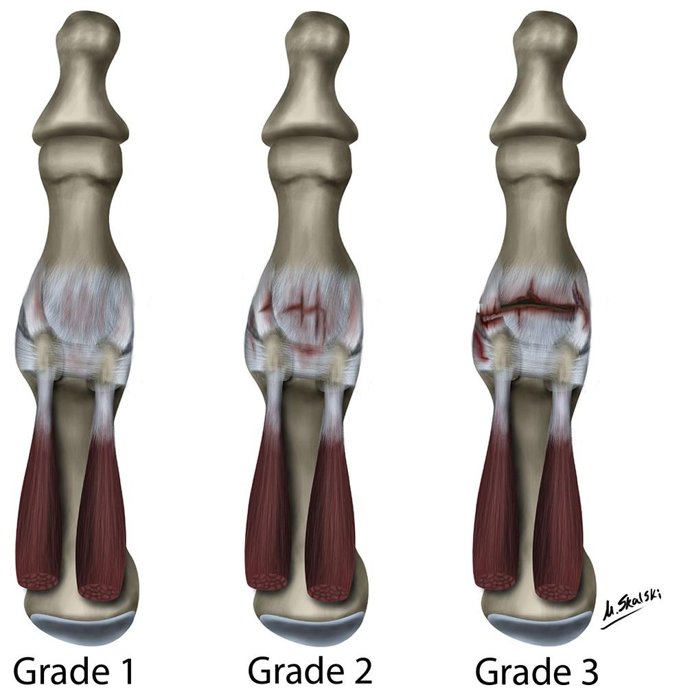 Schematic depicting the clinical grades of turf toe injury.