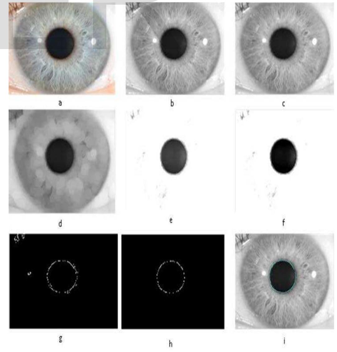 Iris melanoma (a) the original rgb image, (b) the gray-