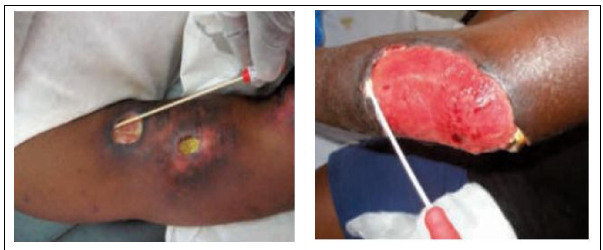 Taking swab from suspected buruli ulcer lesions