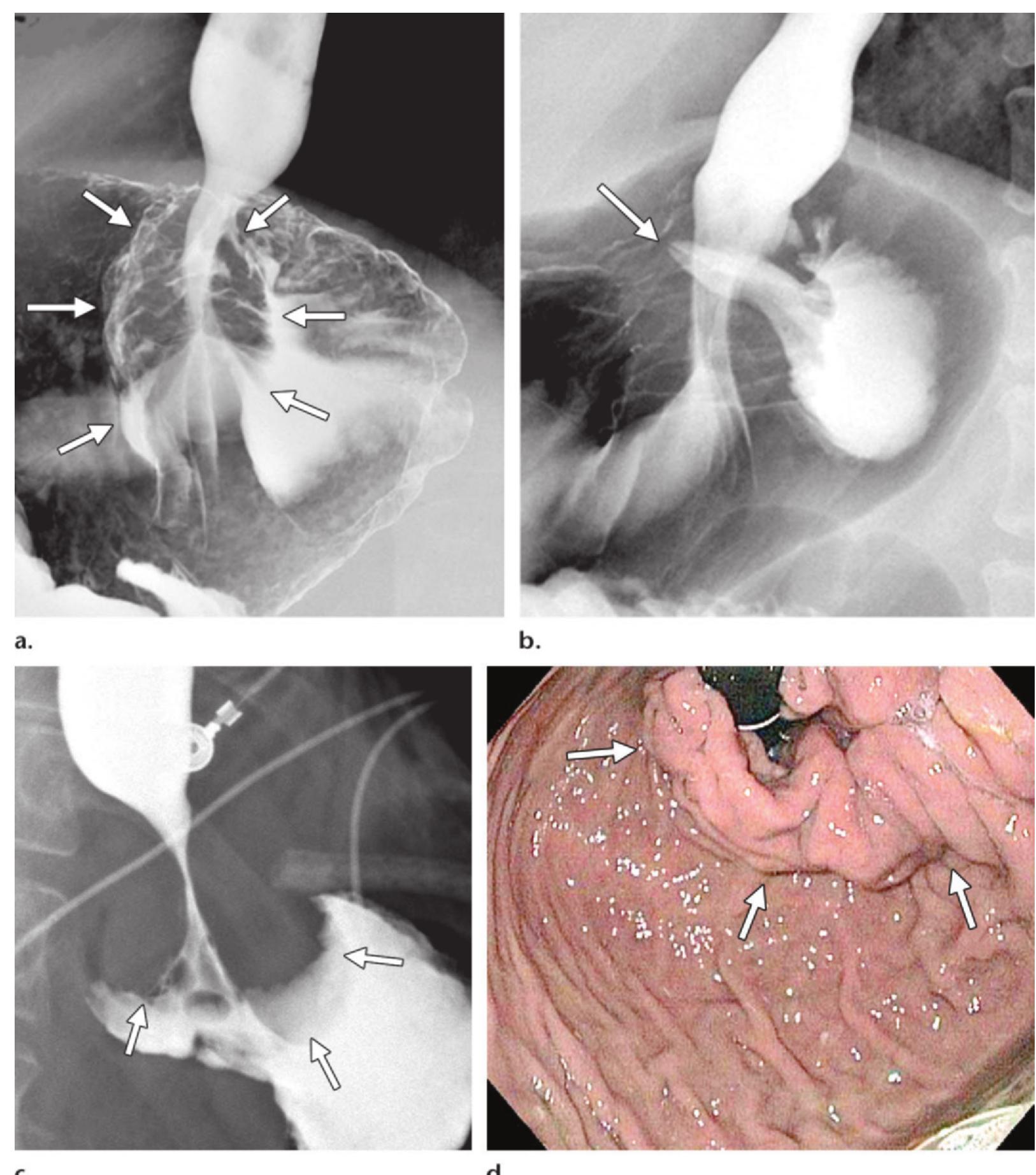 Imaging appearance after fundoplication. (a) image from a
