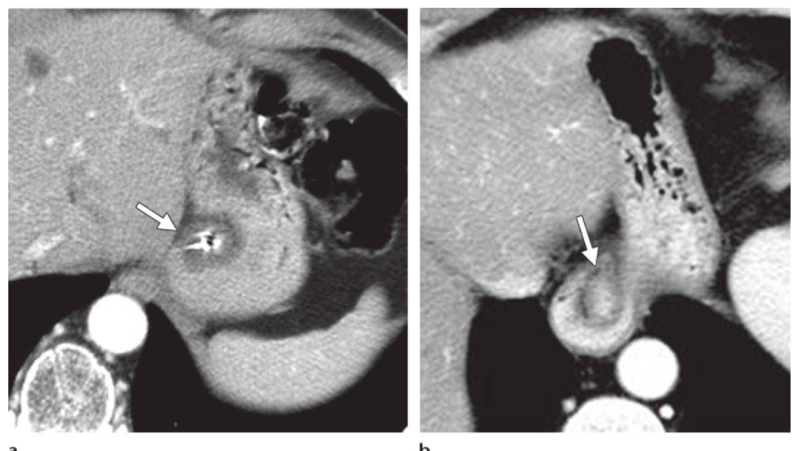 (PDF) Imaging Findings of Successful and Failed Fundoplication