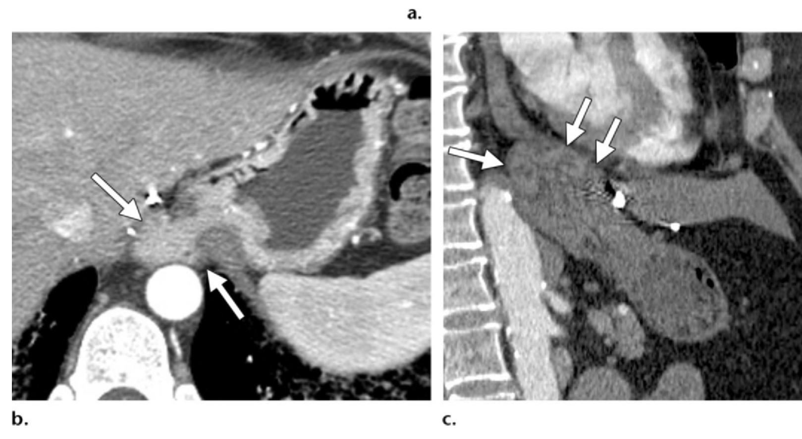 (PDF) Imaging Findings of Successful and Failed Fundoplication