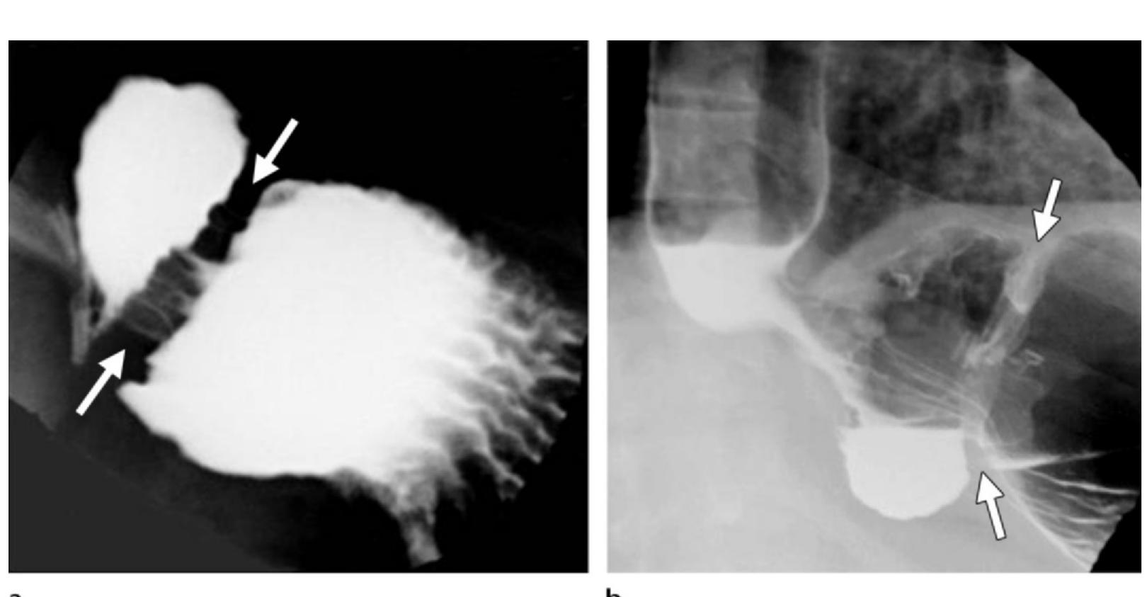 (PDF) Imaging Findings of Successful and Failed Fundoplication
