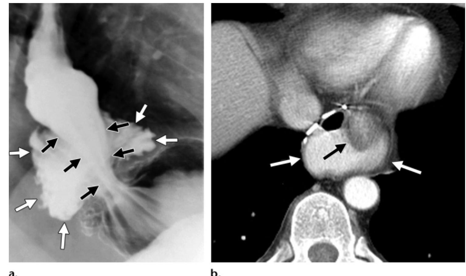(PDF) Imaging Findings of Successful and Failed Fundoplication
