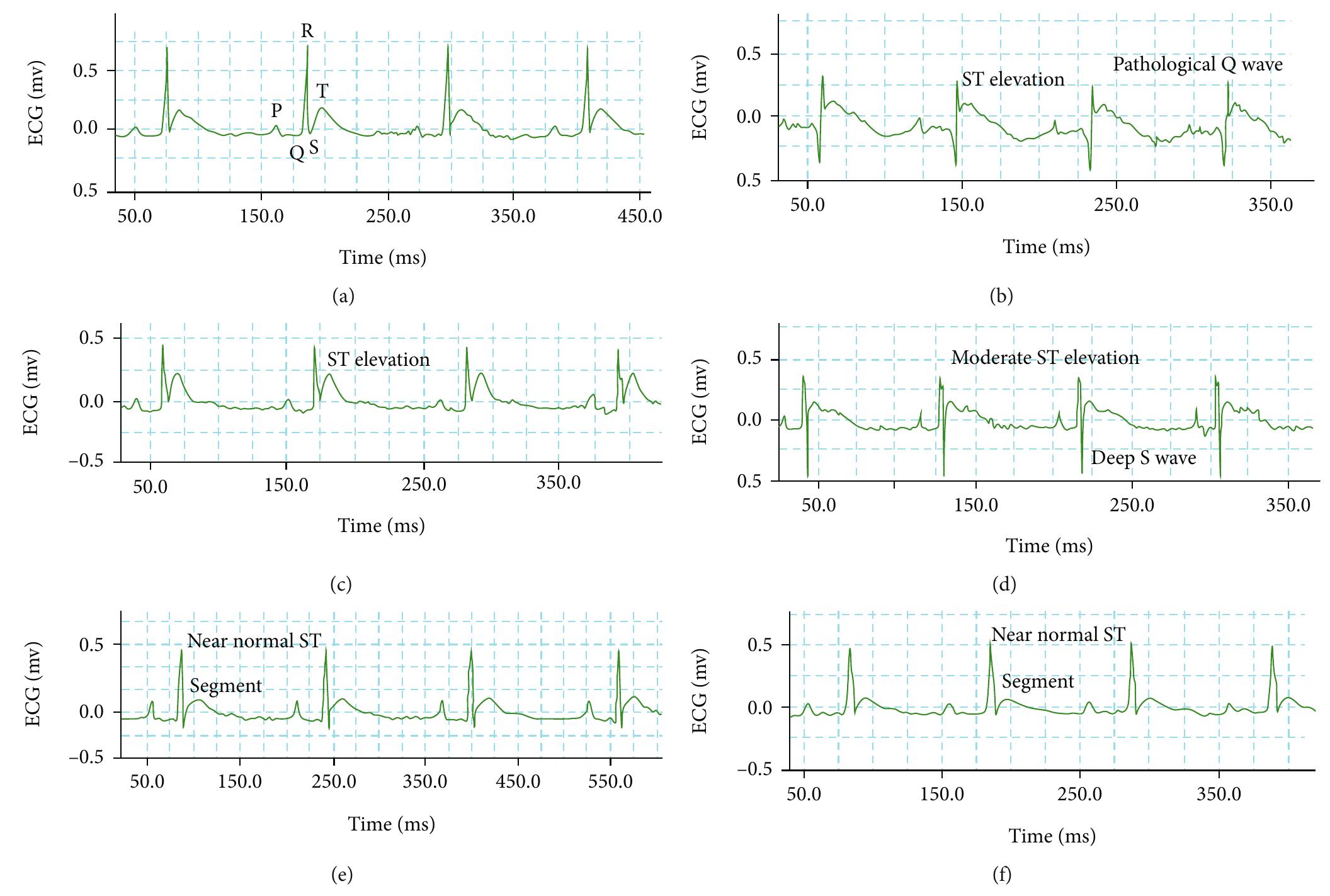 Representative electrocardiogram (ecg) tracing of (a)
