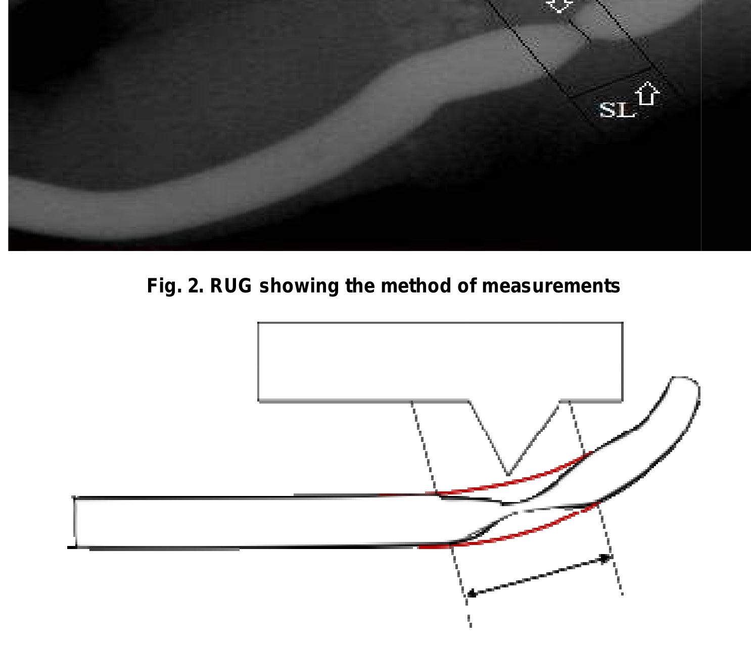 Line diagram showing the stricture measurement method in rug