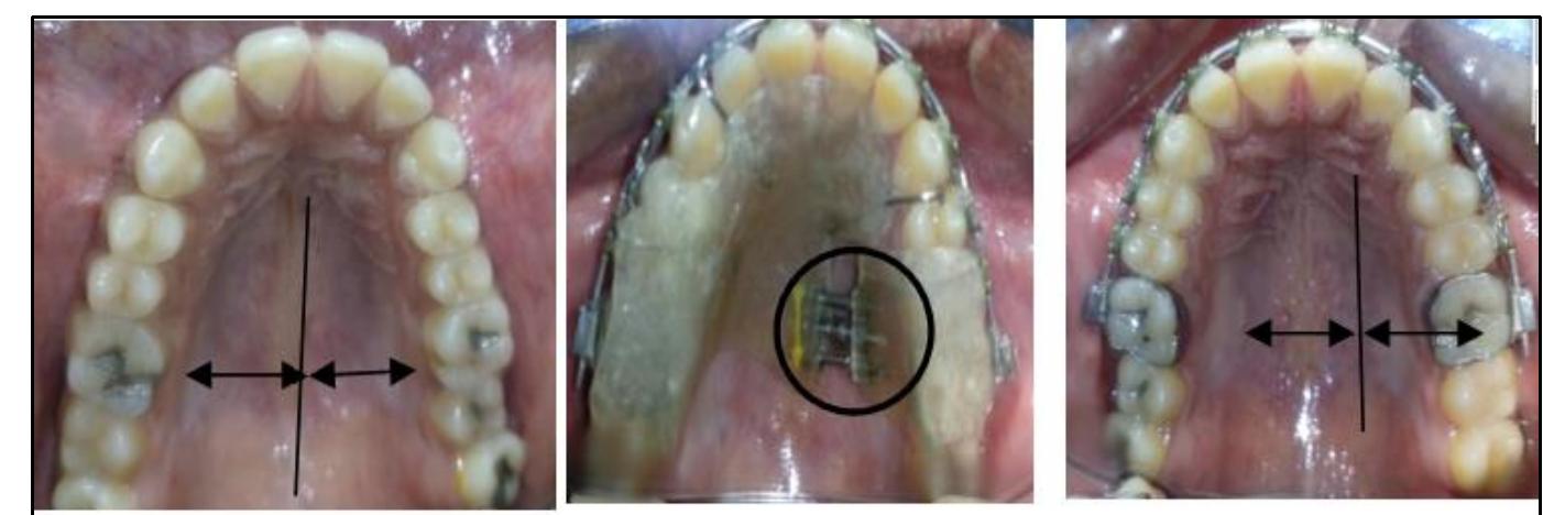 (c): showing maxillary arch expansion on right side