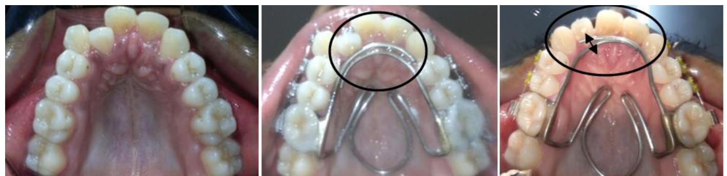 (c): maxillary arch photographs: before, during and after