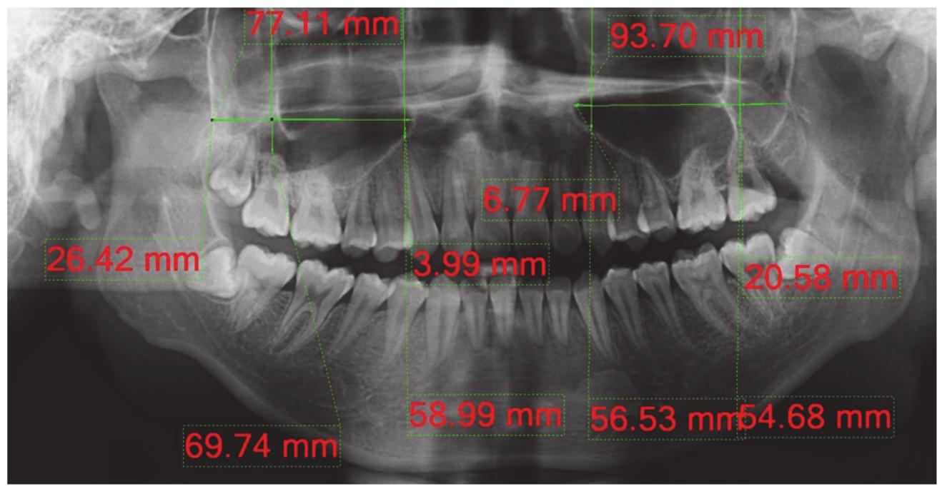 Measurement of the maxillary sinus using panoramic x-ray,