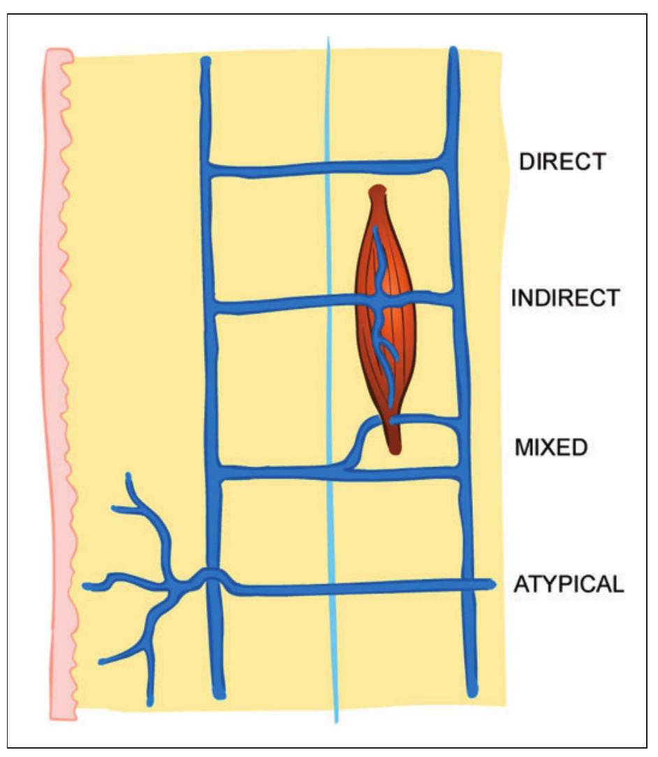 General types of perforating veins: direct, indirect, mixed