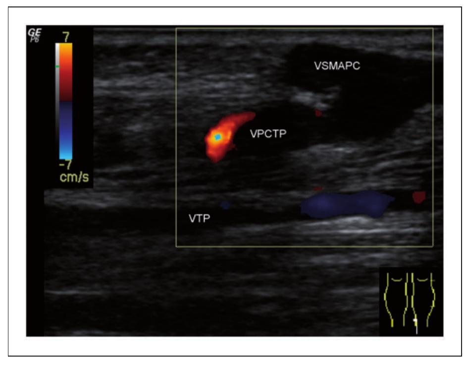 (PDF) The venous perforators of the lower limb – A new terminology