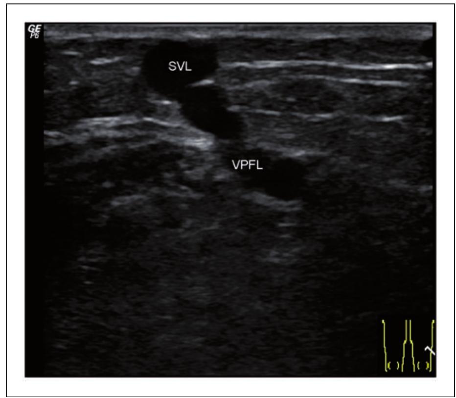 I]. ultrasound of a dilated vena peforans femoris lat-