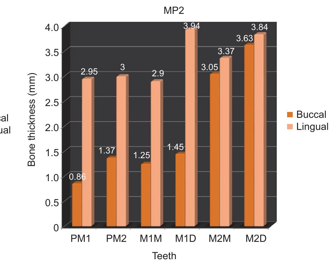 Figure 5 - Alveolar Bone Dimensions of Mandibular Posterior