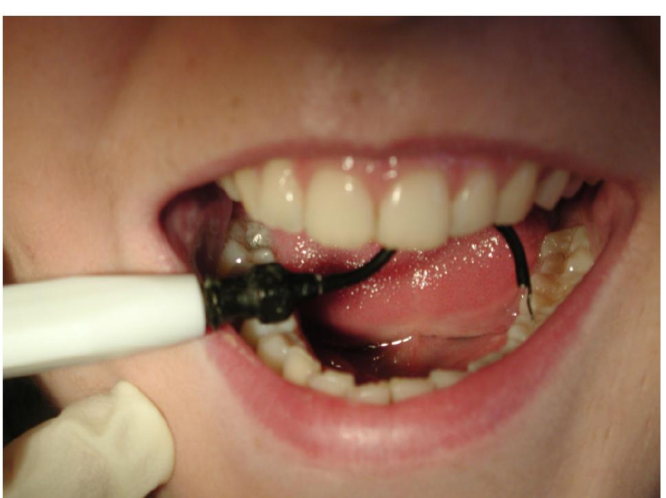 Figure 10 Clinical Occlusal Caries Detection Methods To