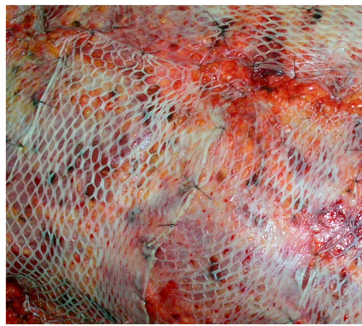 Intermediate-thickness skin grafts on a burn wound.