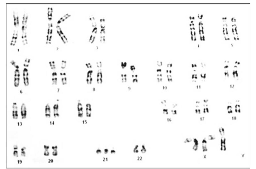 (PDF) Double trisomy (XXX+21 karyotype) in a six-year-old girl with down phenotype