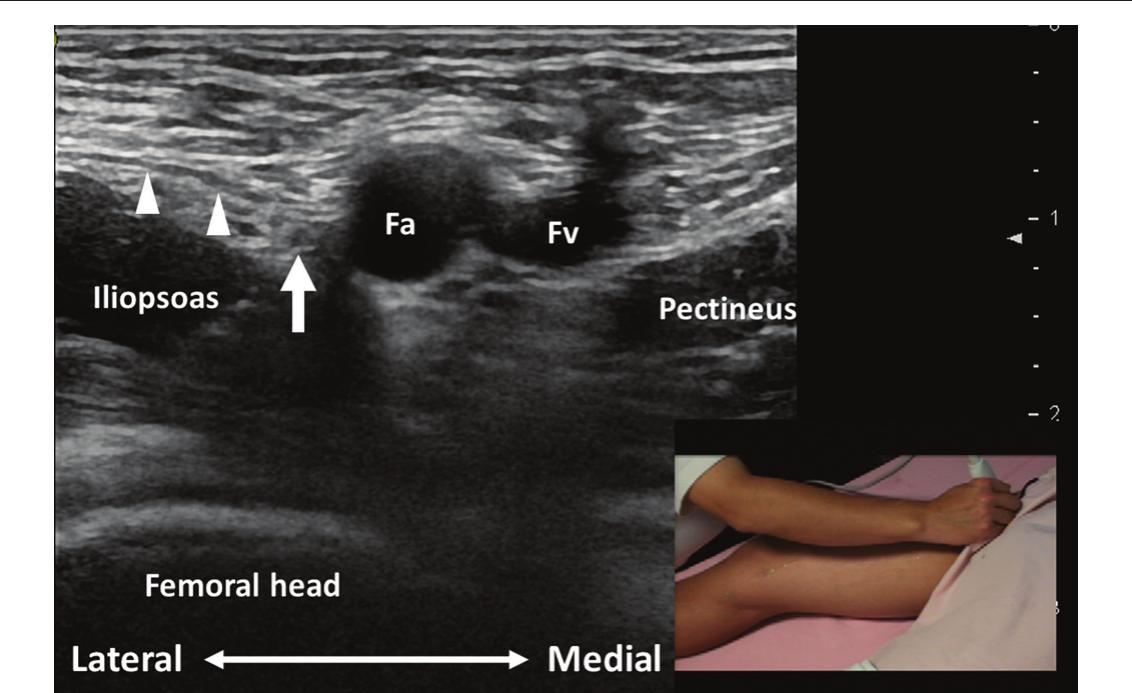 - 10) (us image (axial view) shows the femoral nerve (arrow)