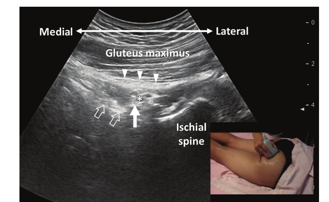 Jre 3 us image (axial view) shows the pudendal nerve (arrow)