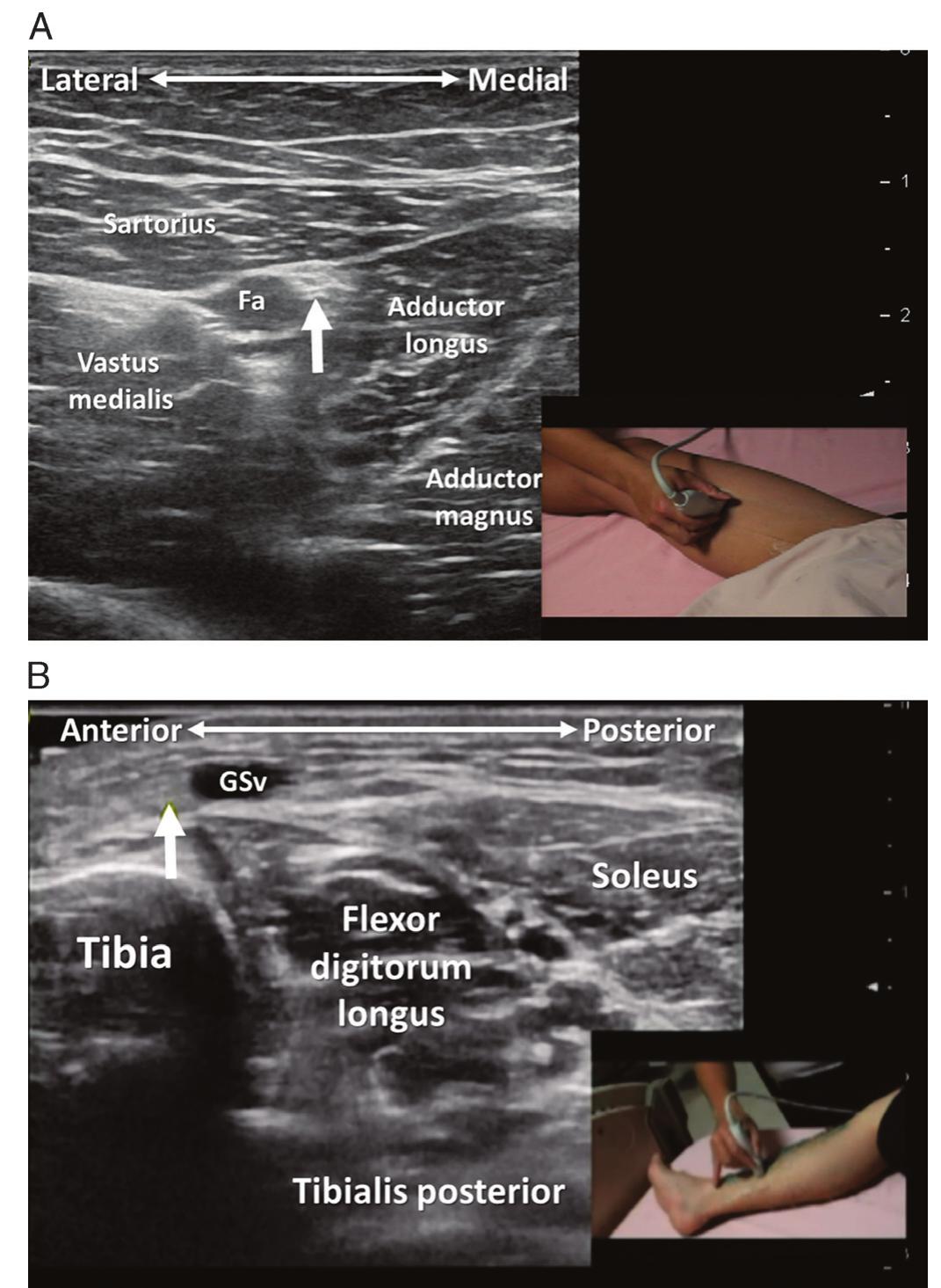 Re 6 a, us image (axial view) shows the saphenous nerve