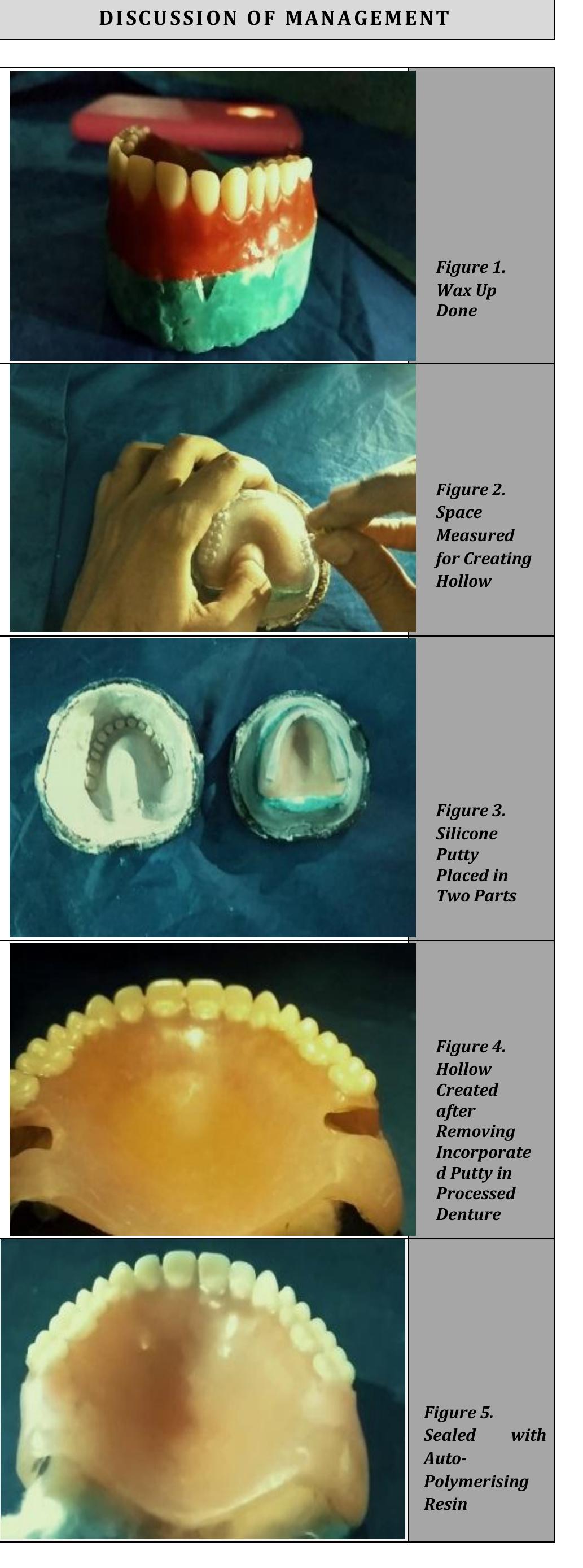 Figure 1 - Fabrication of Hollow Maxillary Complete Denture