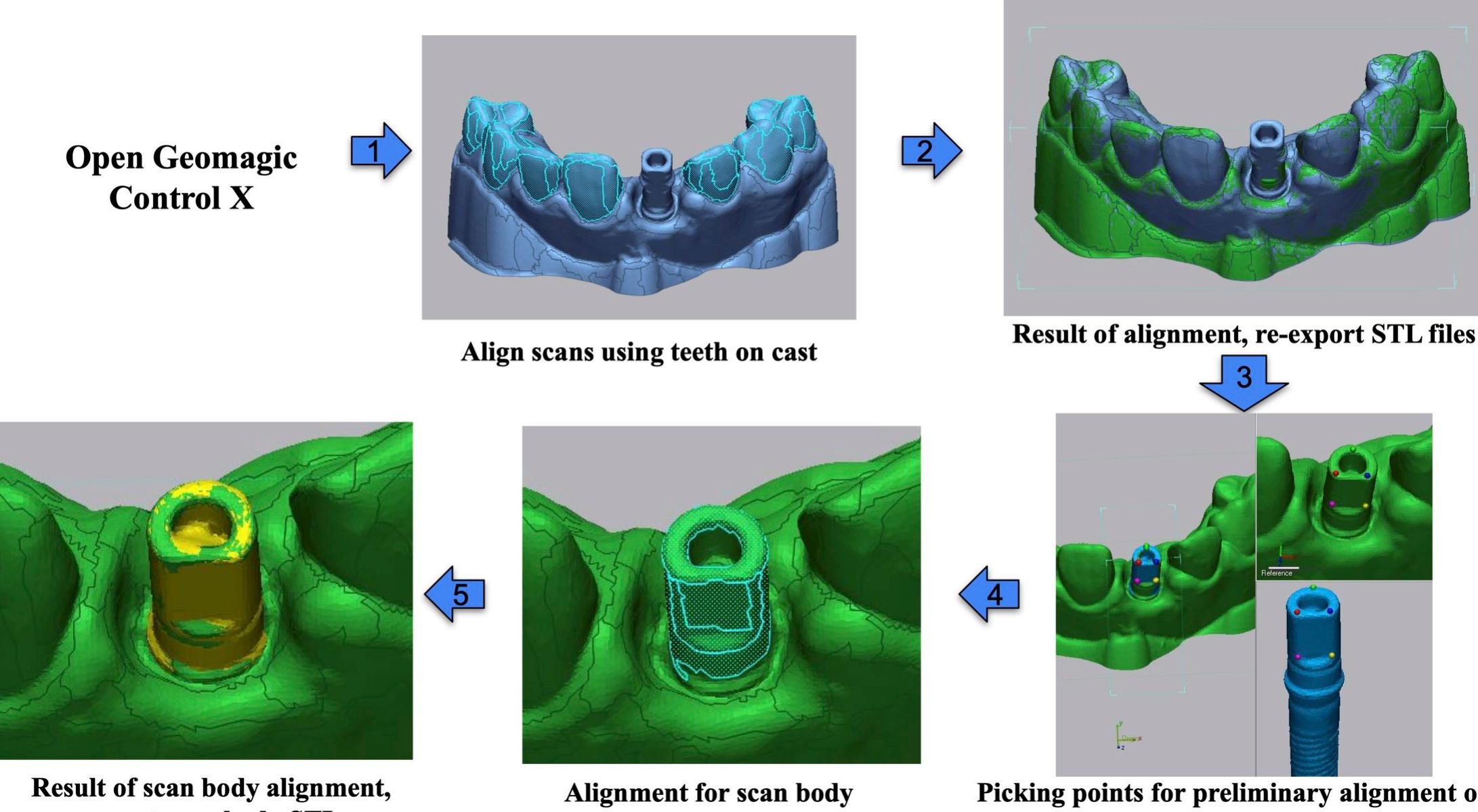 Superimposition of the casts and the scan bodies. once the