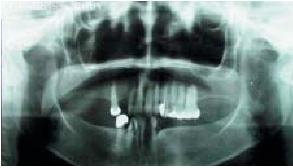 Ortopantomografia. proceso infeccioso periapical del 23.