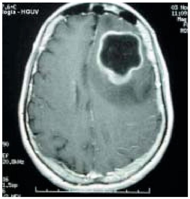 Tac cerebral corte coronal: absceso cerebral. brain ct scan,
