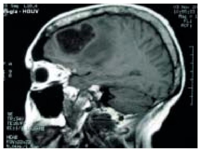 Tac cerebral corte sagital: absceso cerebral. brain ct scan,