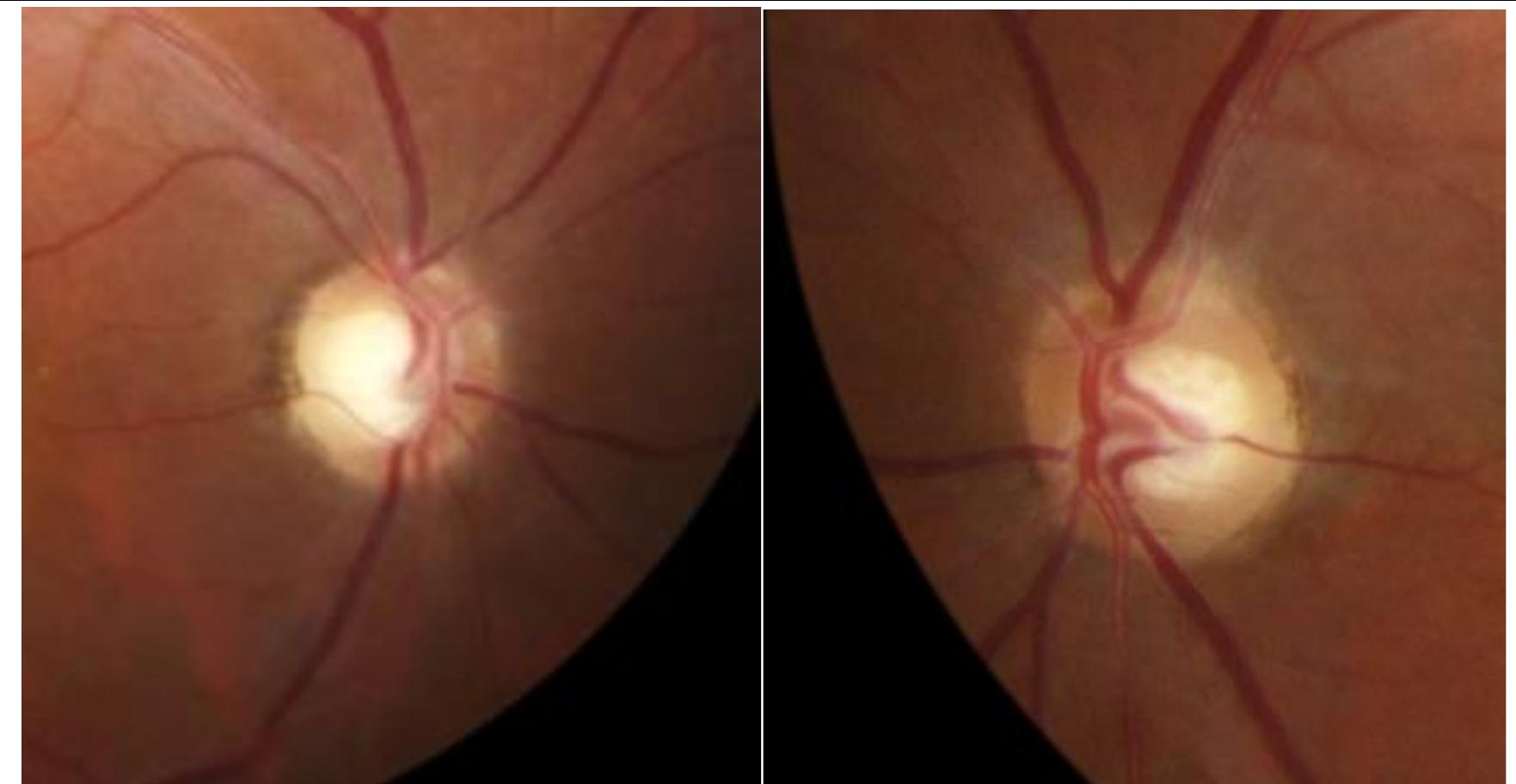 Example of glaucomatous optic nerve excavation. the