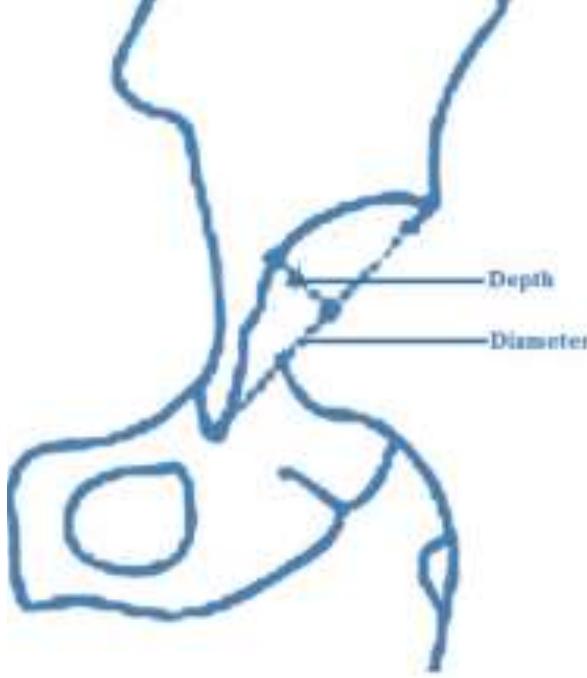 Figure 1 - from Study of Morphometric Analysis of Acetabulum