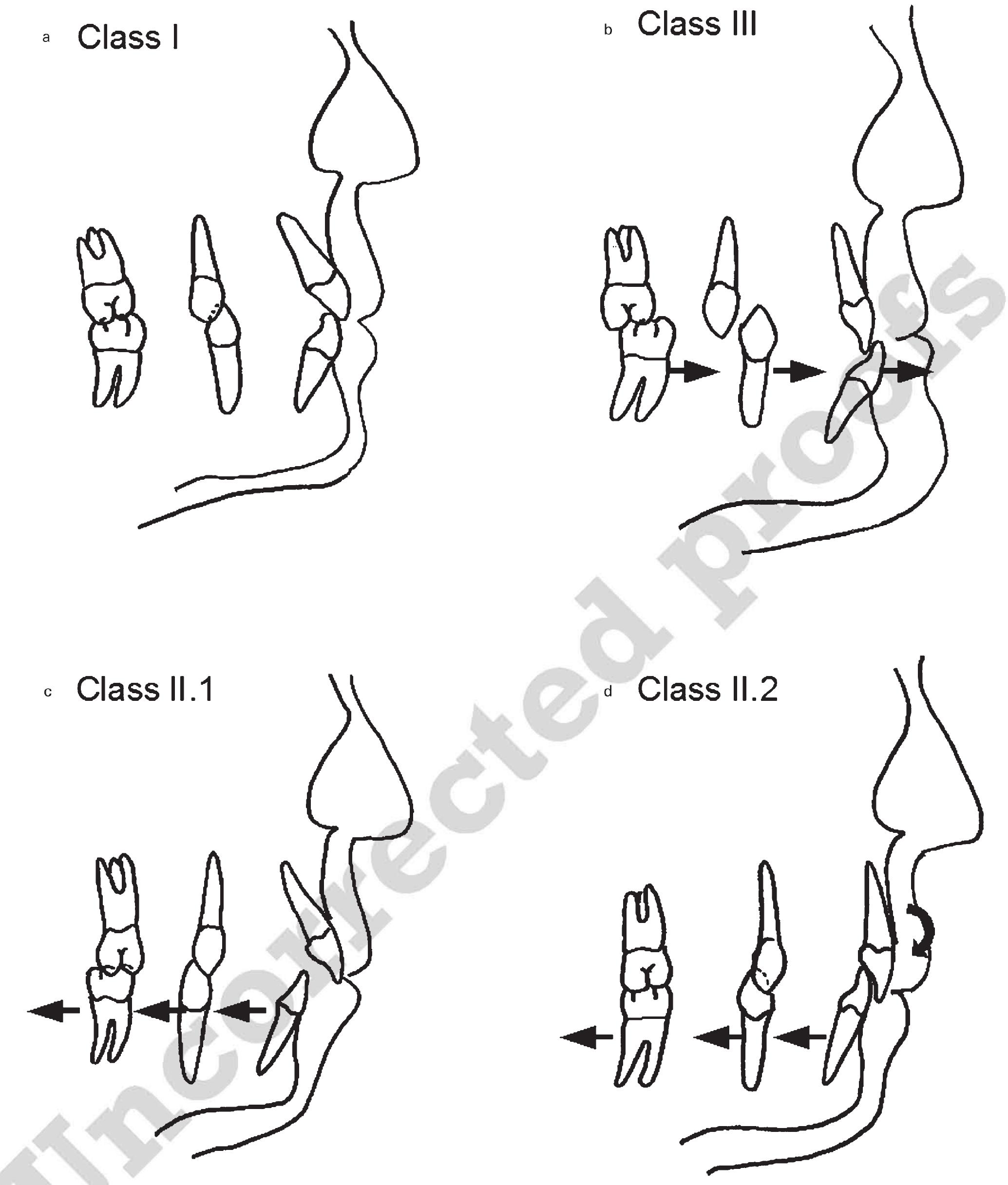 Schematic visualization of sagittal dental anomalies, and