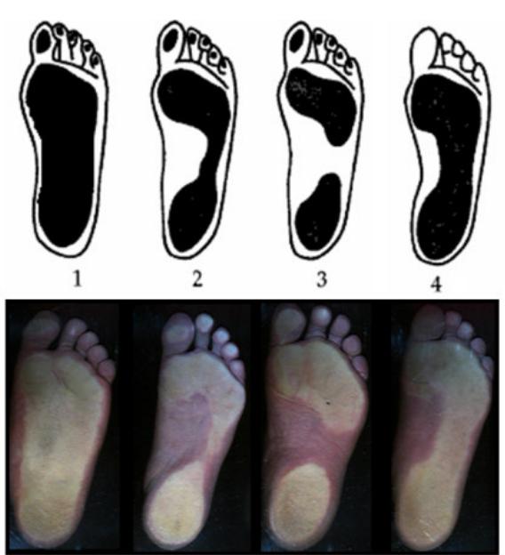 Foot type (1) flat foot, (2) pes cavus grade ii (3) pes
