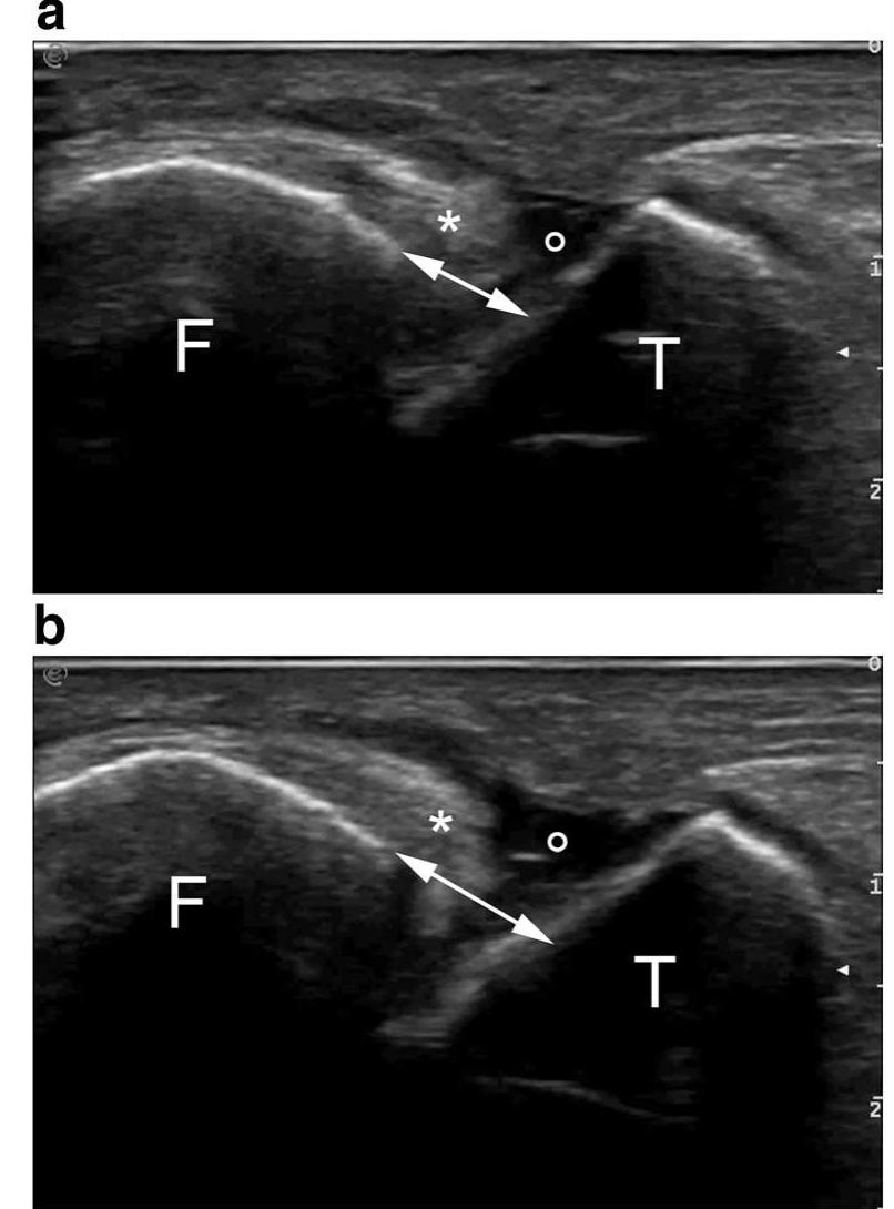 Dynamic evaluation of lateral ankle instability in a patient