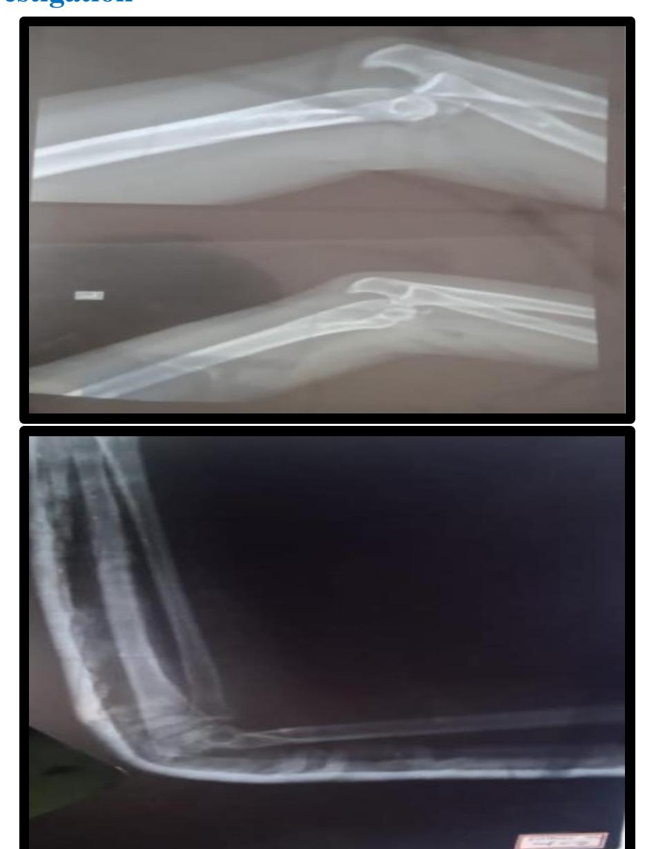 Pre- and post-x-ray after close reduction of elbow