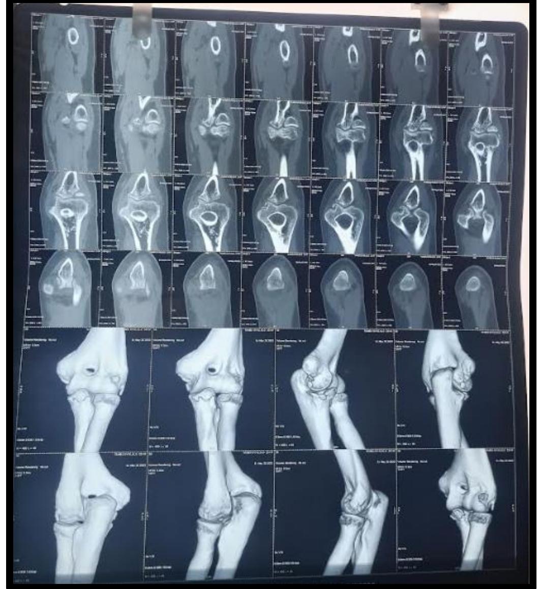 Ct scan after close reduction of left elbow dislocation