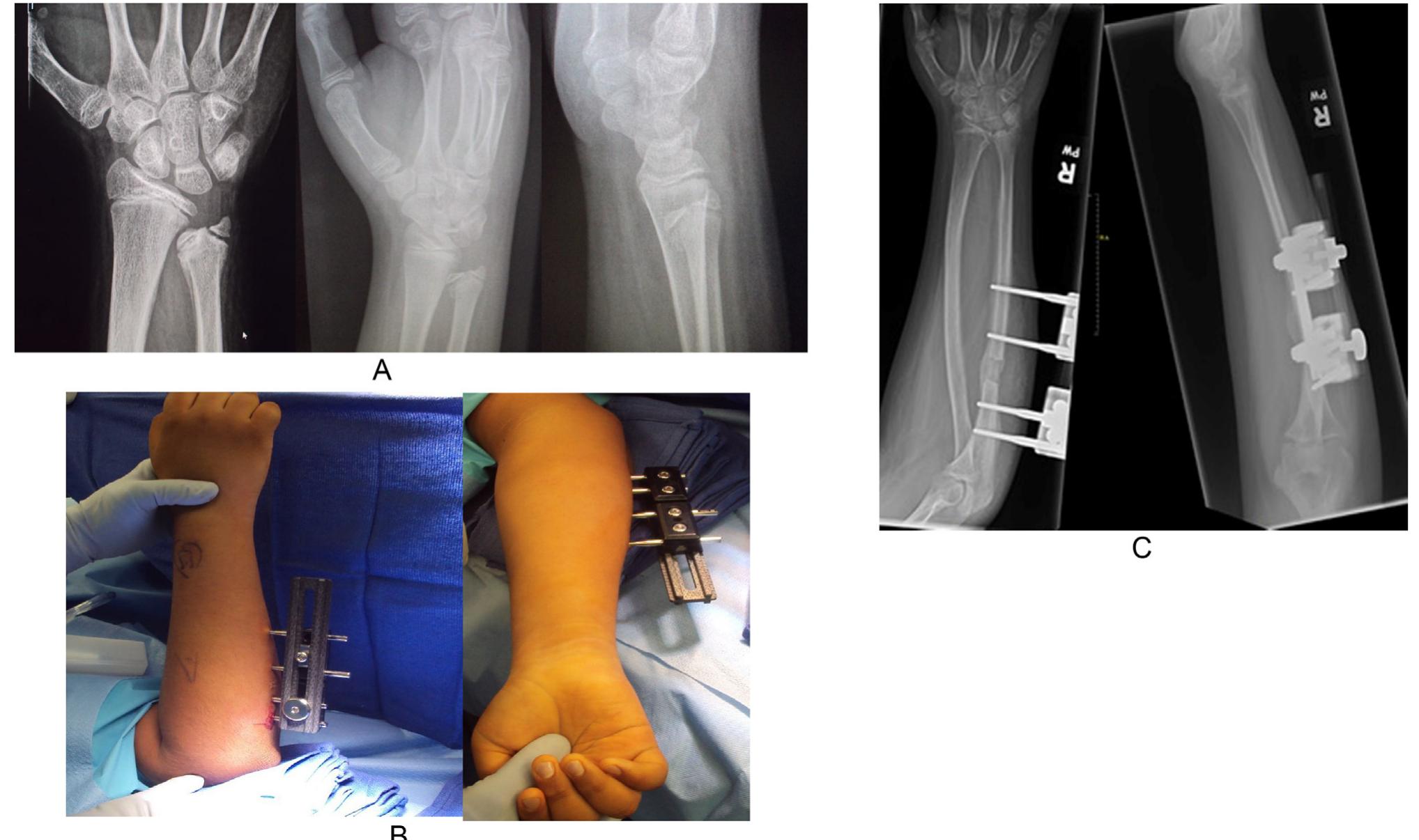 A: ap, oblique, and lat x-rays of the hand and wrist joint