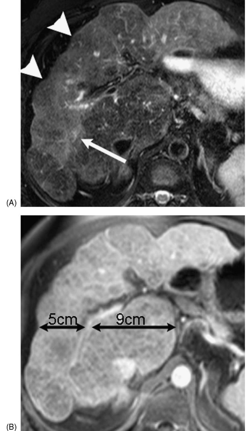 Typical cirrhotic morphology at mr imaging. transverse