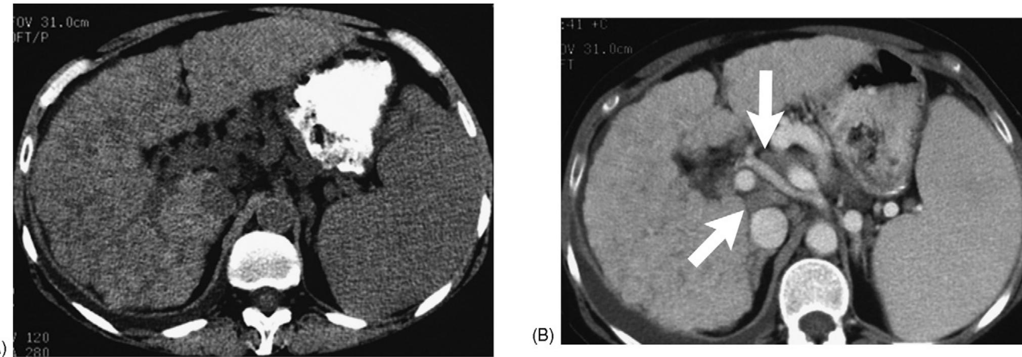 Primary biliary cirrhosis at ct. (a) transverse nonenhanced